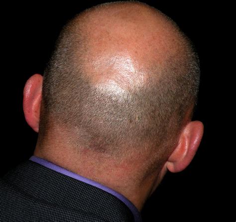 7 Signs That You Will Go Bald And How To Prevent This From Happening Daily Family