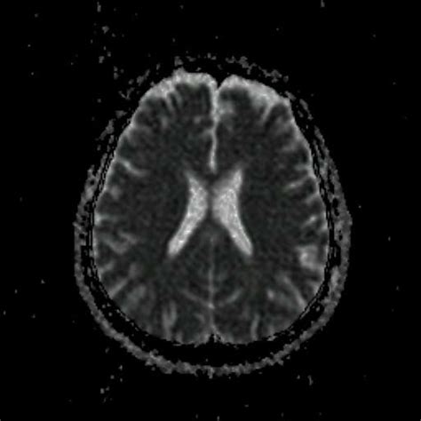 Adc Map Calculated From The Three Diffusion Images Download Scientific Diagram