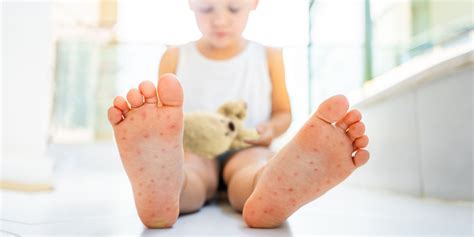 Vor Allem Kleine Kinder Betroffen Hand Fuß Mund Krankheit