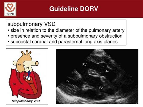 Ppt Dgpk Guideline Double Outlet Right Ventricle Dorv Powerpoint Presentation Id 4836689
