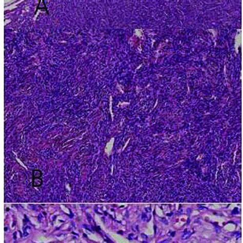 Pathological Examination With Hematoxylin Eosin Stain A The Tumor