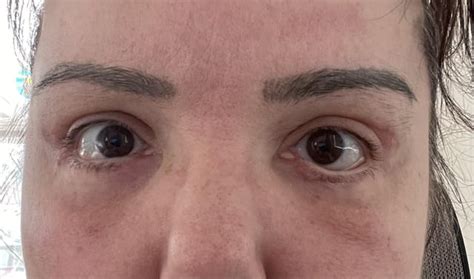 6 Weeks Post Upper Lower Blepharoplasty And Canthoplasty Normal R