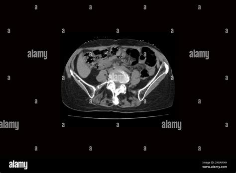 Computed Tomography Of The Spine With A Fracture Of The Vertebrae And