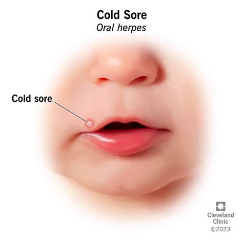 Cold Sore On Lower Lip