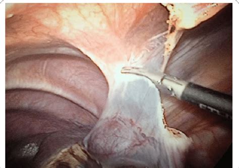Image Of The Hepatic Lesion Was Implanted In The Falciform Ligament
