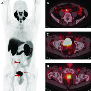A Anterior Whole Body Maximum Intensity Projection Image From The