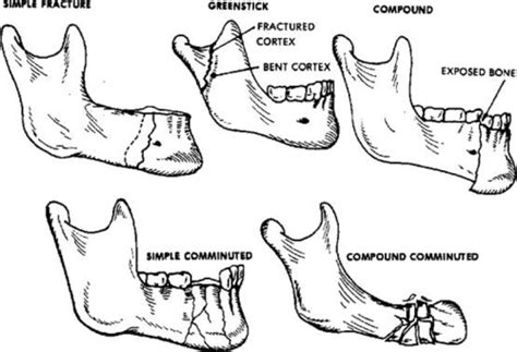 Mandible Fracture Classification