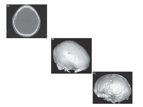 Tbi Definion And Their Types Well Explained Ppt