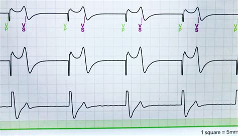 Permanent Pacemaker Interrogation Showing Inappropriate Ventricular