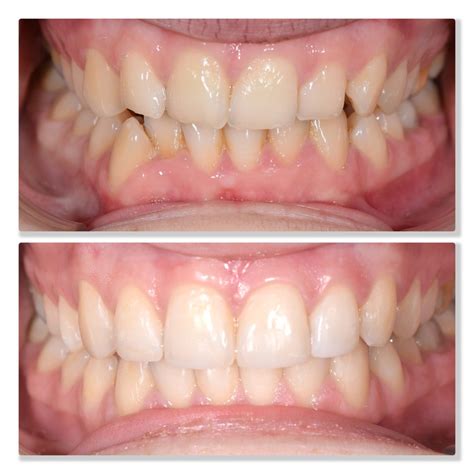 Invisalign And Composite Infinity Dental Clinic