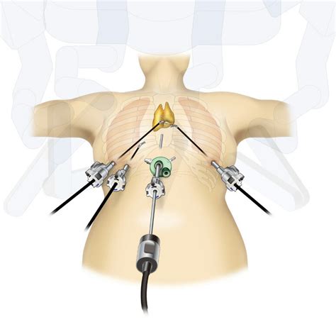 Location Of Ports In The Subxiphoid Approach Download Scientific Diagram