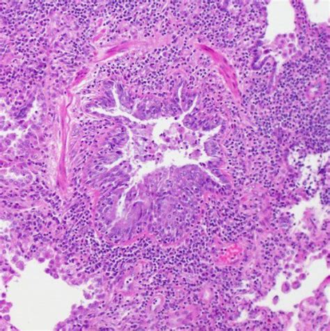 000 Follicular Bronchiolitis Lungs