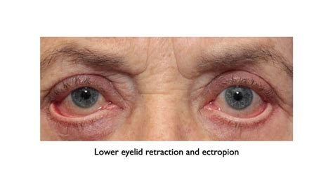 Lid Retraction Subperiosteal Midface Lift With Or Without A Hard