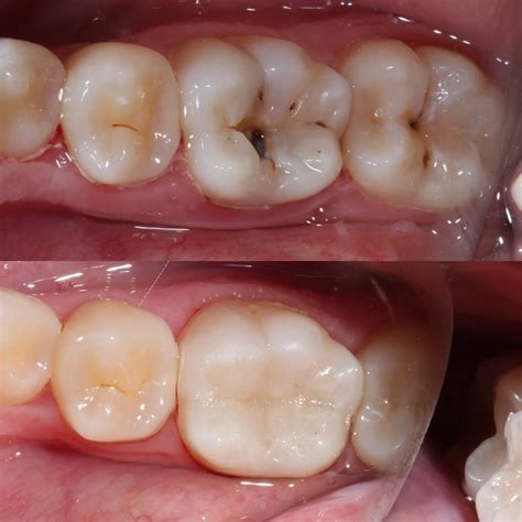 Tooth Surfaces