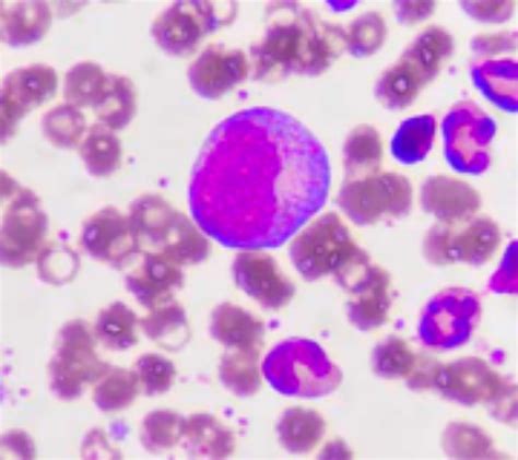 Using Available Evidence And Guidelines For Managing An Evolving Aml