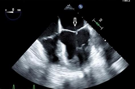 A Transesophageal Echocardiogram Tee Showed A Small Mobile