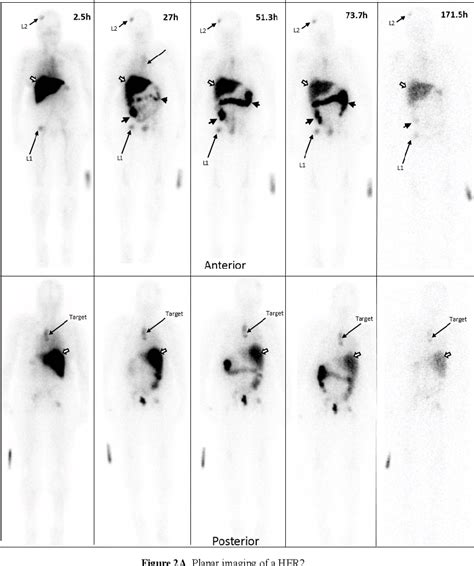 Figure 2 From First In Human Phase 0 Study Of 111in Chx A” Dtpa