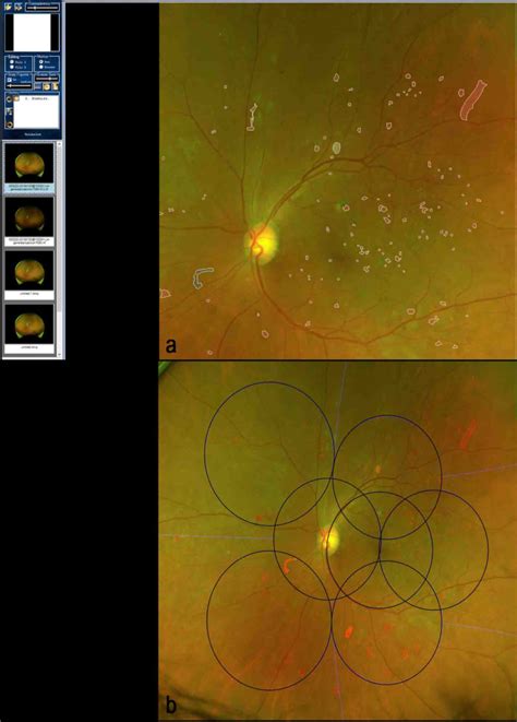 Graefe S Archive For Clinical And