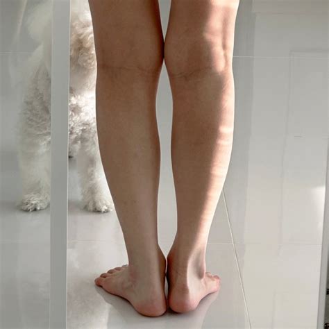 하이힐주사 1년 후 다시 맞은 후기 종아리보톡스알빼기부종통증가격전후 네이버 블로그