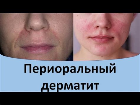 Пероральный дерматит лечение основные причины и симптомы
