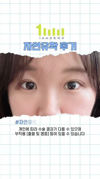 비절개 쌍수 자연유착 후기 [1mm성형외과]｜ [일미리성형외과] Youtube