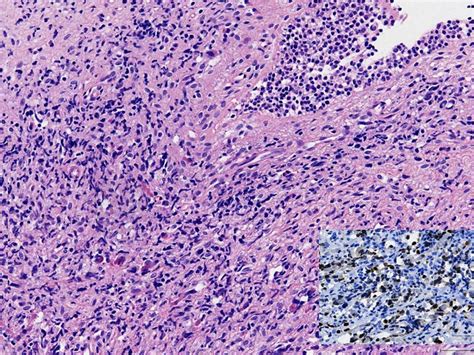 Sarcoma Botryoides Urethra