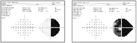 Case 1 Postoperative Humphreys Central 24 2 Visual Field Demonstrates