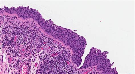 Urothelial Carcinoma In Situ Archives Ottawa Atlas Of Pathology