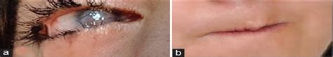 Dental Management Of Tricho Dento Osseous Syndrome In Adoles Dental Research Journal