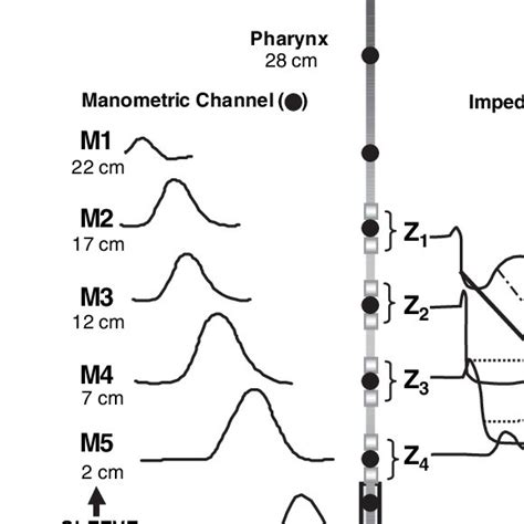 Schematic Depiction Of The Combined Perfusion Manometry And Impedance