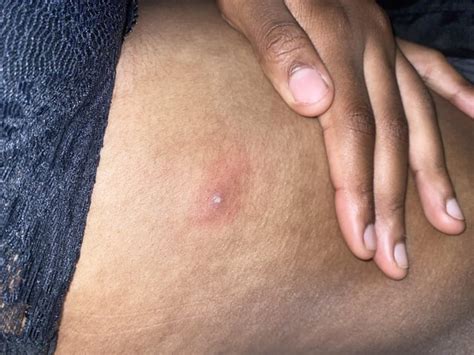 Bug Bite Or Staph Infection R Bugbites