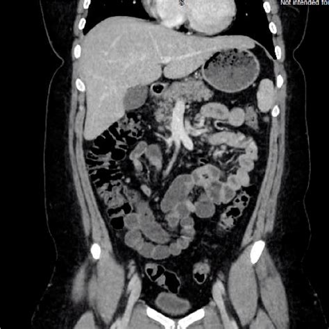 Gross Anatomy Glossary Small Intestine Ileum Imaging Ditki Medical