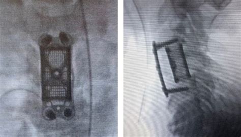 3d Printed Implants The Top Applications 3dnatives