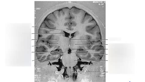 Interpeduncular Fossa Mri