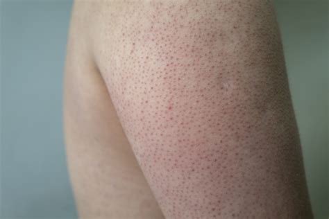 Say Goodbye To Chicken Skin Forgotten Skincare