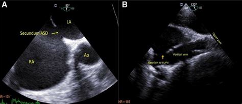 Transesophageal Echocardiography Images A Two Dimensional Tee Image Download Scientific