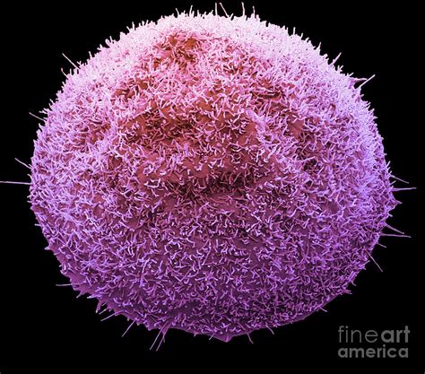 Colon Cancer Cells Under Microscope