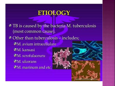 Tuberculosis Cavernous Tuberculosis Pptx