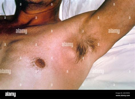 Bubonic Plague Swollen Lymph Node Or Bubo Under The Arm Of A Patient