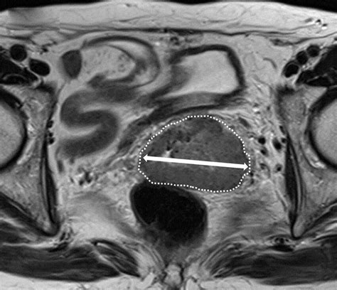 The Horizontal Tumor Diameters Were Measured Based On The Axial