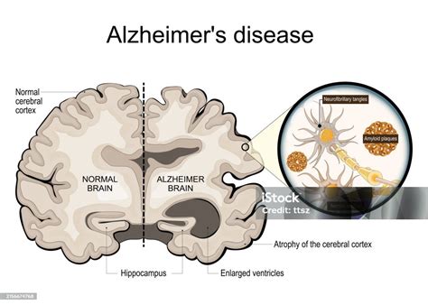 Alzheimer Disease Hippocampus Closeup Of Neurons With Neurofibrillary