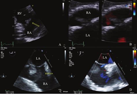 A Tte In The Parasternal Rv Inflow View Showing A Shaggy Appearing Download Scientific A Tte In The Parasternal Rv Inflow View Showing A Shaggy Appearing Download Scientific