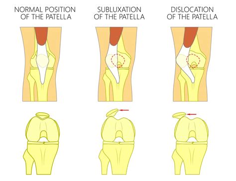 Physical Therapy Exercises For Patellar Subluxation Online