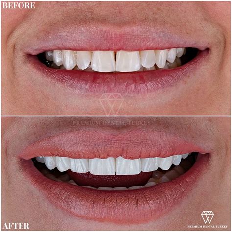 Smile Makeover Turkey Smile Makeover Abroad Smile Makeover Costs