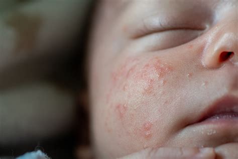 Neonatal Acne
