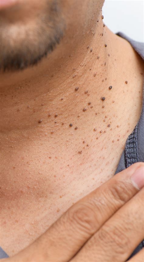 Benign Skin Lesions Dermatology Aesthetics My Xxx Hot Girl
