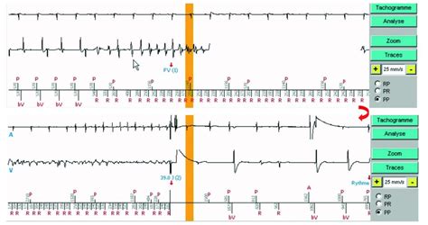 Fibrillation Ventriculaire Définition Cause Symptômes Traitement