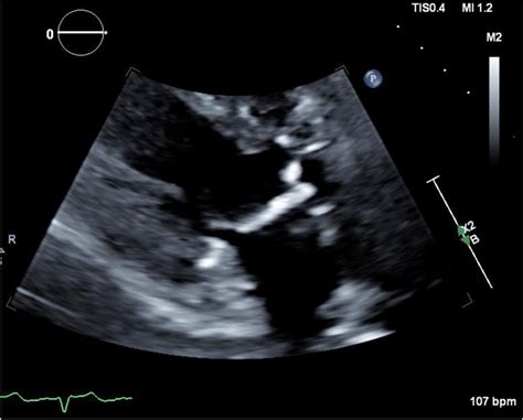 Transthoracic Echocardiography Measuring Aorto Mitral Curtain