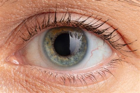 What Is Neovascular Glaucoma Iris