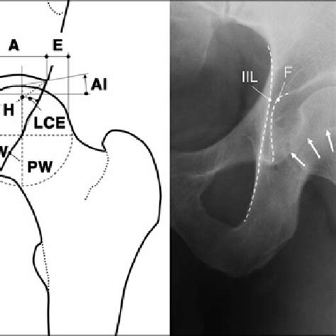 Schematic Left And Radiographic Right Appearances Of Normal Hip